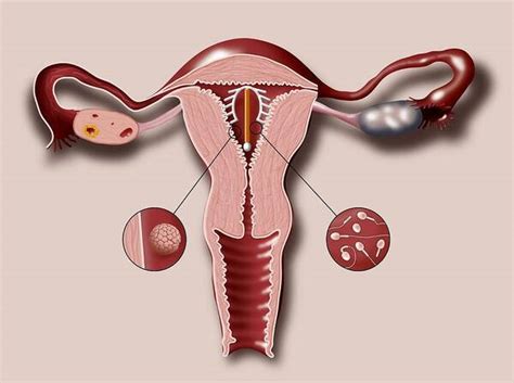 Contraceptive Coil In Uterus Artwork Art Print By Science Photo