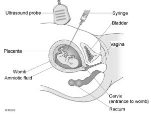 Amniocentesis Definition Procedure Risks Benefits Sciencevivid