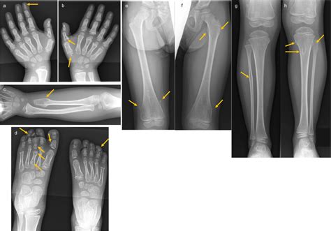 Radiographs Of Proband A B Multiple Bilateral Metacarpal And