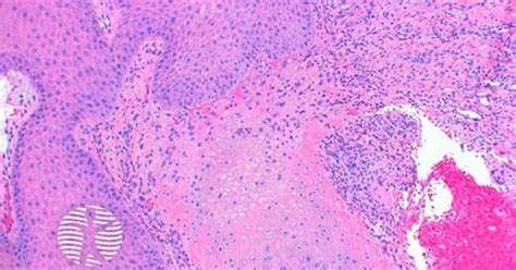 Chondrodermatitis Nodularis Helicis Pathology Image