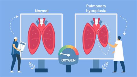 Pulmonary Hypoplasia About Restrictive Lung Disease 1228964 Vector Art