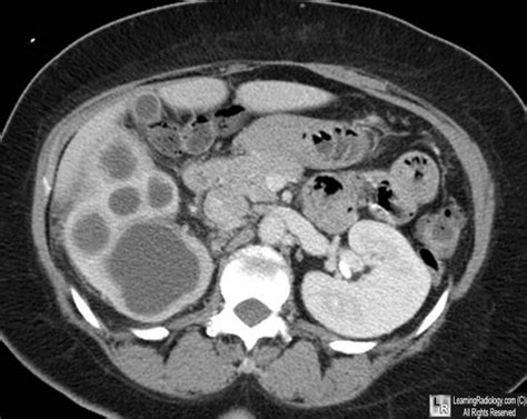 Learning Radiology Bear Paw Sign