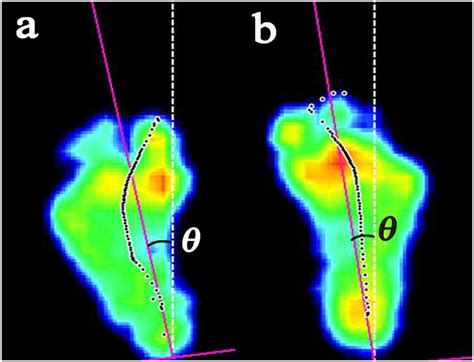 Examples Of The Foot Progression Angle The Purple Line Is Located
