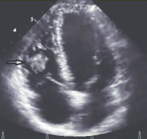 The Echocardiography Showed A Normal Left Ventricle Ejection Fraction
