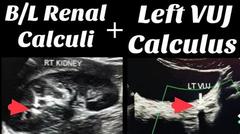 Bilateral Renal Calculi Left Vuj Calculus Youtube