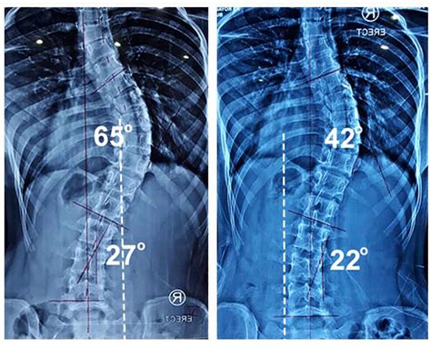 Perbedaan Brace Gbw Schroth Brace Dengan Brace Rigid