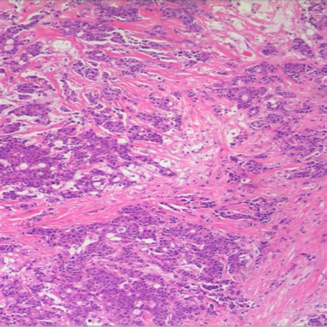The Pathological Diagnosis Of The Resected Specimens Was Lung