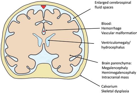 Fetal Macrocephaly Pathophysiology Prenatal Diagnosis And Management
