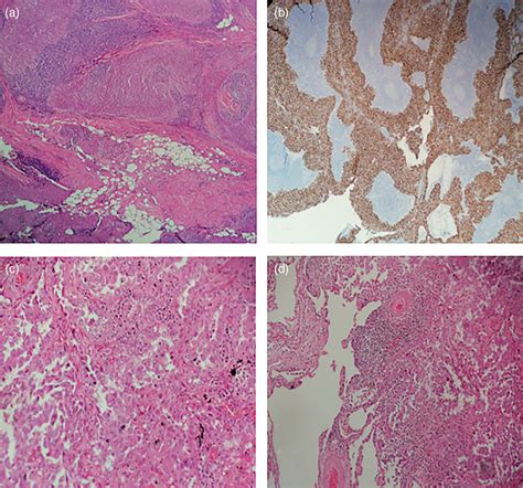 A Microphotographs Of Thymic Carcinoma B Thymic Carcinoma With Download Scientific Diagram