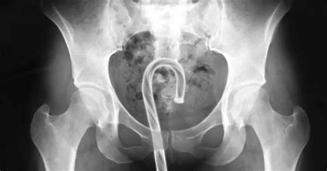 Most Bizarre Objects People Put In Their Bodies Before Ending Up At Aande