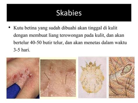Cutaneous Larva Migrans Ppt