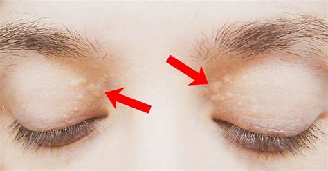 How To Get Rid Of Cholesterol Deposits Around Your Eyes Small Joys
