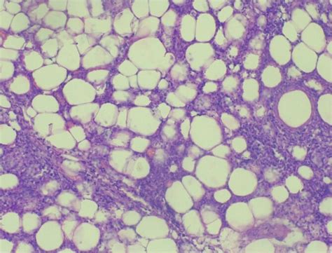 Giant Lipoma With An Unusual Anatomical Location Successfully Managed