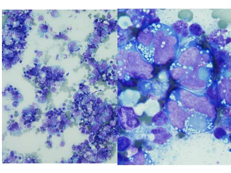 Pleural Fluid College Of American Pathologists