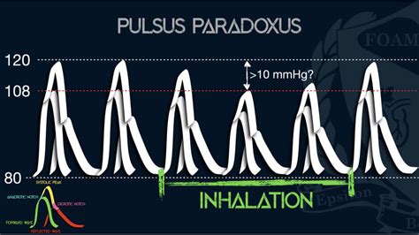 Foamfrat You Ever Find Pulsus Paradoxus On Anyone For