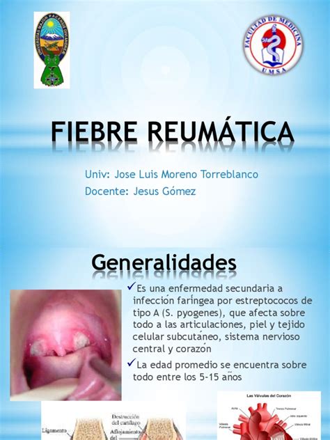 Fiebre Reumatica Streptococcus Medical Specialties