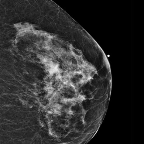 Rsna Mammography Png Dataset Kaggle