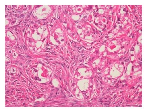 Microscopic Findings For Ovaries A D And The Sigmoid Colon E F Download Scientific