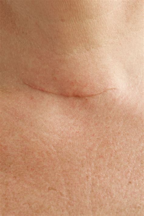 Thyroid Surgery Thyroidectomy Prep And Recovery