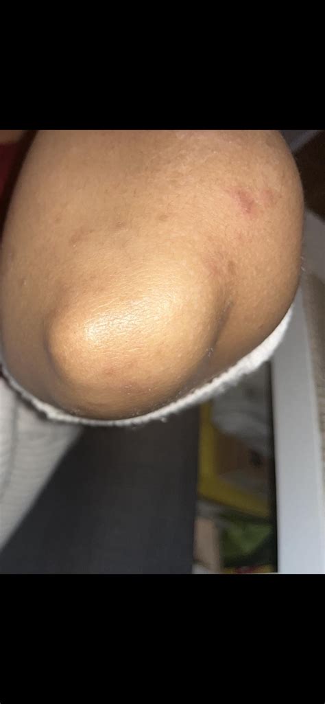 Anyone Get Rashes On Their Elbows Like This Rdermatologyquestions