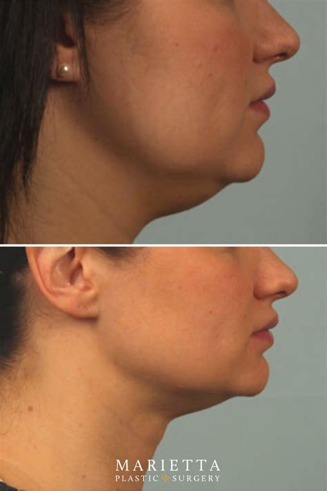 Coolsculpting Double Chin Results Artofit