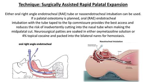 Surgically Assisted Rapid Palatal Expansion Sarpe Pptx