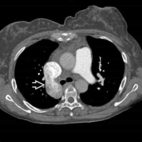 Asplenia And Polysplenia Radiology Key