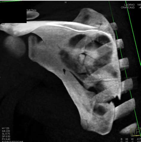 Scapula Fracture Ct Scan At David Rogge Blog