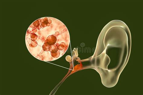 Otitis Media Supurativa Crónica Stock De Ilustración Ilustración De