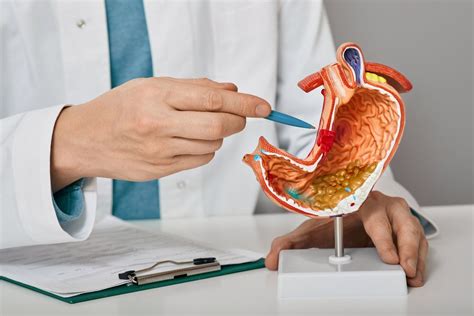 What Is A Gastric Ulcer What Is The Way To Get Rid Of Gastric Ulcers
