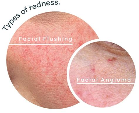 Erythema Redness And Flushing Treatments Anue
