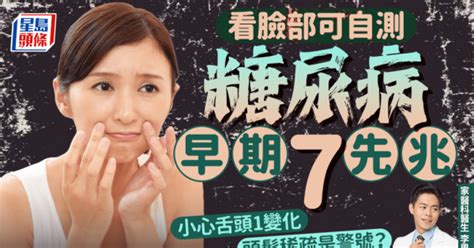 看臉部可自測 糖尿病早期7大先兆！小心舌頭1變化 頭髮稀疏也是警號？ 星島日報