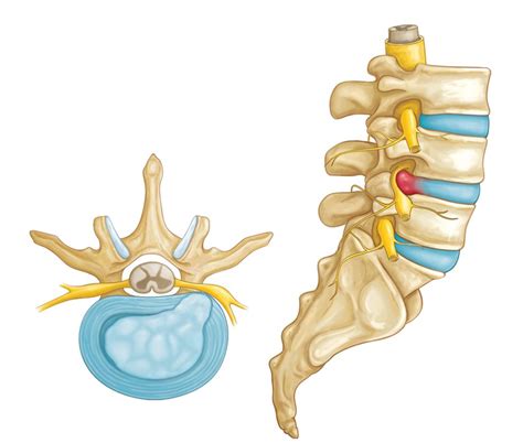 Lumbar Disc Protrusion Management Core Healthcare