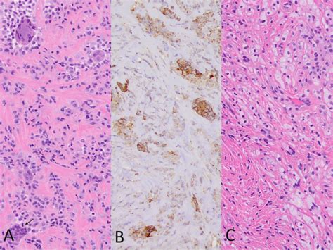 A Osteoclast Like Giant Cells Small Histiocytoid Cells And Larger
