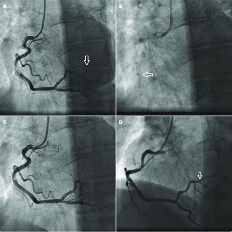 Patient 2 A Large Thrombus In The Right Coronary Artery And Distal