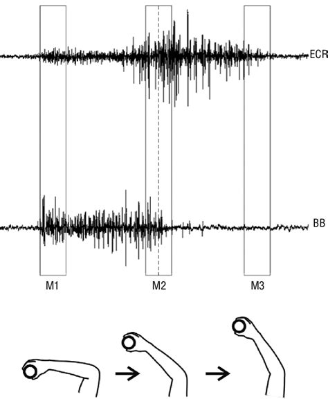 This Schematic View Illustrates How The Surface Electromyographic