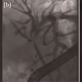 Single Operator Cholangioscopy In A Patient With An Indeterminate Hilar Download Scientific