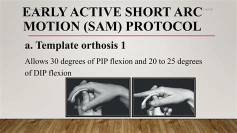 Lecture 21 Extensor Tendon Injuries Pdf