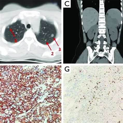 Laparoscopic Mass Image Pictures Gross Specimen And Pathologic Download Scientific Diagram