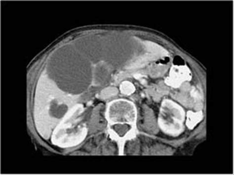 Abdomen And Retroperitoneum 11 Liver Case 114 Liver Cysts