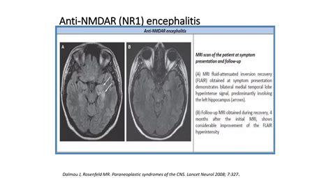 Anti Nmda Receptor Encephalitis Copypptx