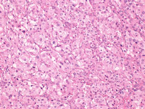 Microscopical Appearance Of Pccsympathetic Pgl Showing Characteristic
