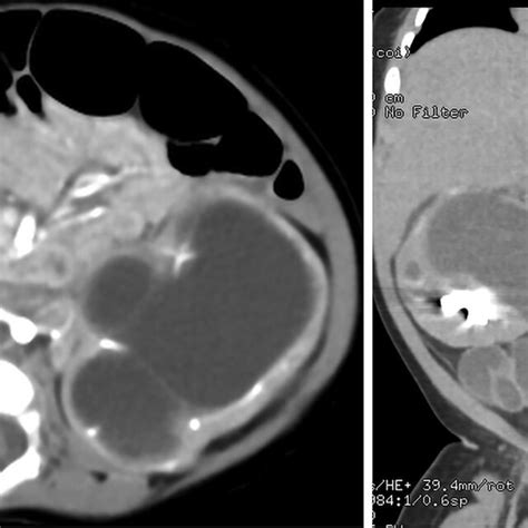 Patients Situation After Bilateral Cutaneous Ureterostomy Download