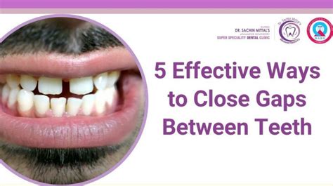 5 Effective Ways To Close Gaps Between Teeth