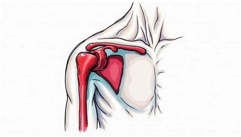 Mri Shoulder Labral Tear Findings What To Look For — Read My Mri