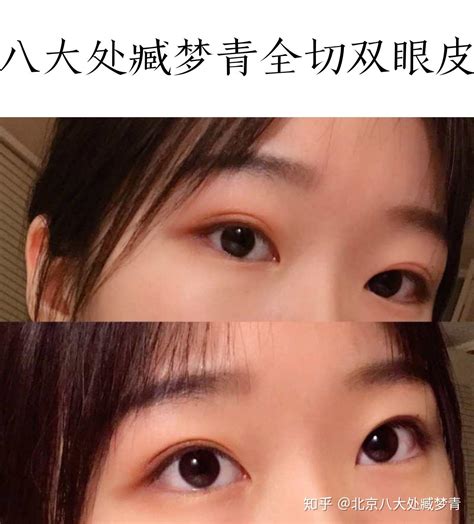 北京双眼皮案例分享 知乎