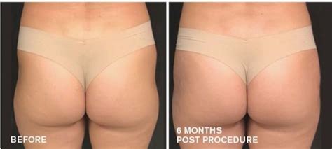 Renuva Fat Transfer Hip Dip Correction Fat Bio Stimulator — Rejuve