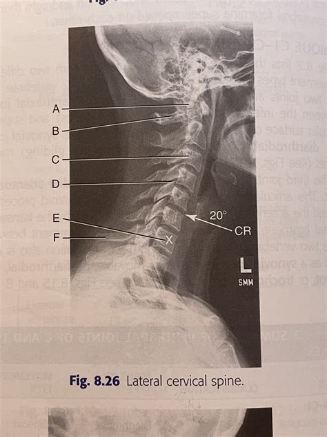 Procedures CH 8 C T Spine Label 11 Lateral C Spine Diagram