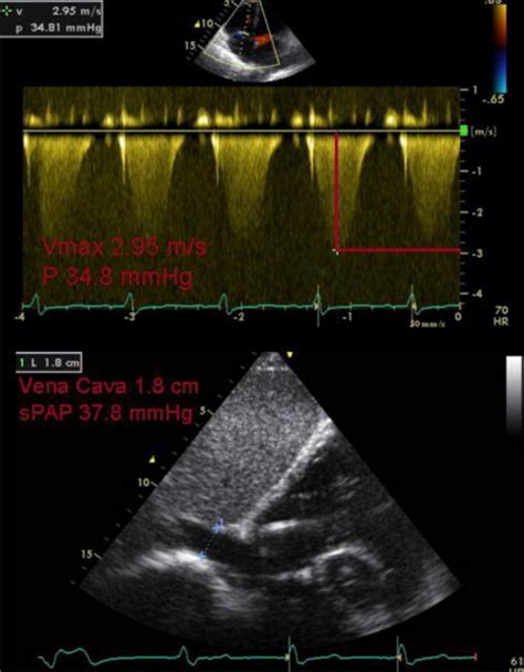 Pulmonary Hypertension And Pulmonary Artery Acceleration Time A Systematic Review And Meta