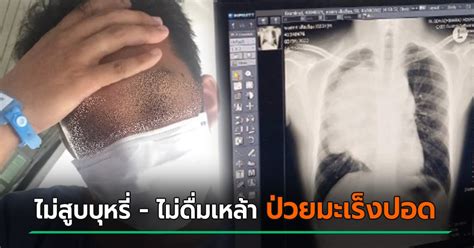 ความคิดเห็น ช็อก ป่วยเป็นมะเร็งปอดในวัย 24 ปี ทั้งที่ไม่ดื่มเหล้า